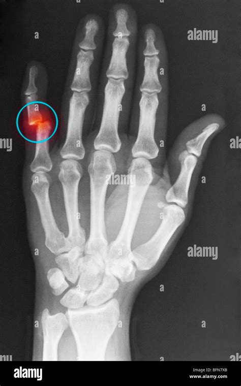 Hand X Ray Showing A Dislocation Of The Proximal Interphalangeal Joint Of The Fifth Finger Stock