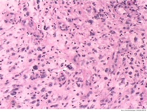 Undifferentiated High Grade Pleomorphic Sarcoma Of Ethmoid Sinus A