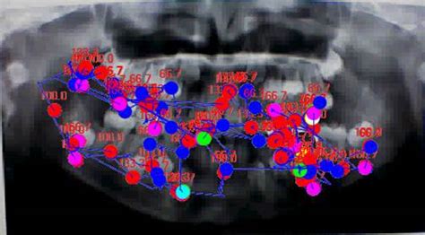 How Do Japanese Babes Observe Panoramic X Ray Photos IADR Abstract Archives