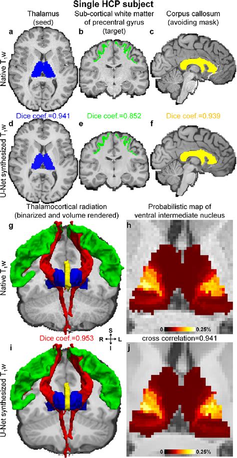 diffusion tractography masks of the seed region thalamus a d