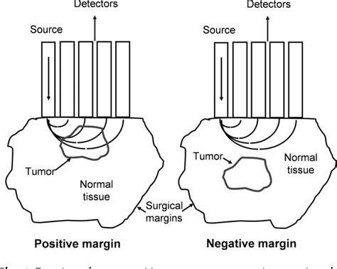 Figure 1 From Spatially Offset Raman Spectroscopy For Surgical Margin