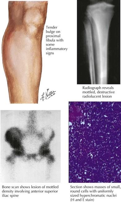 Bone Neoplasms Clinical Gate