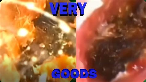How To Removal Earwax At Home With Hydrogen Peroxide Ear Wax Removal