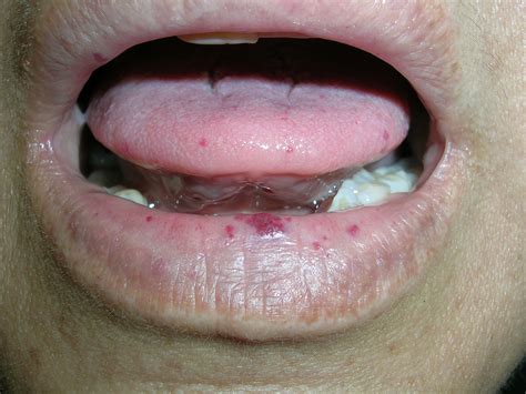 Red Spots On Lips And Tongue