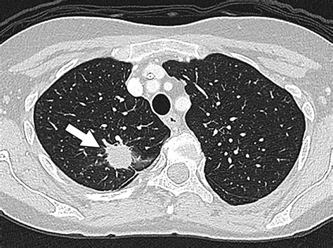 Management Of Pulmonary Nodules In Oncologic Patients Ajr Expert Panel