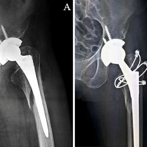 Interprosthetic Femur Fracture Classification As Described By Pires Et Al Download Scientific