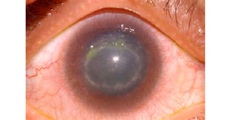 Nummular Keratitis