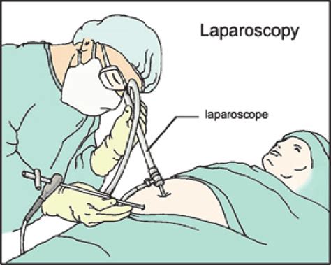 Laparosocpy In Some Cases Asymptomatic Women Endometrial Implants Have Download Scientific