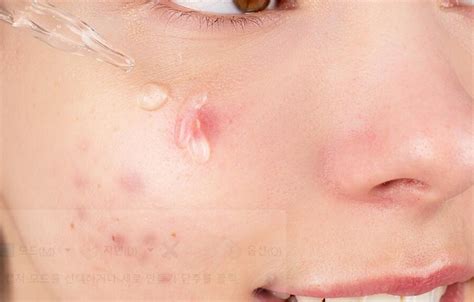 여드름의 종류와 원인 및 치료법 호율안 [소소한 이야기]