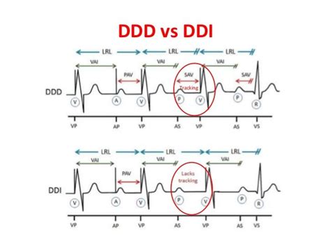 Understanding Pacemakers