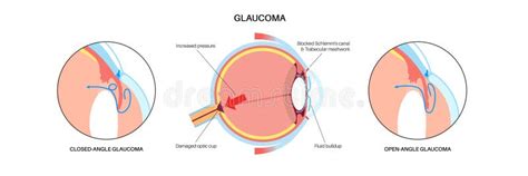 Glaucoma Ilustración Del Vector Ilustración De Natalia 325082529