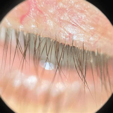 Demodex Blepharitis Xdemvy® Lotilaner Ophthalmic Solution 0 25