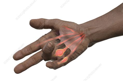 Dupuytrens Contracture Illustration Stock Image F038 1061 Science Photo Library