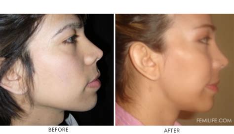 Cheek Feminization Femilife