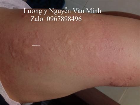 H Nh Nh D Ng Da Ch Ng B Nh Ng S Hay Ch L T C Ng C A M I Tr Ng Nh P V Xem Ngay