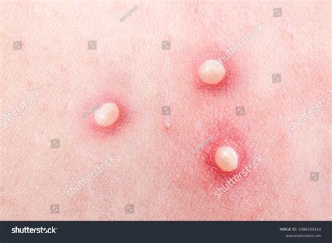Skin Pustules Common Lumps And Bumps On And Under The Skin What Are
