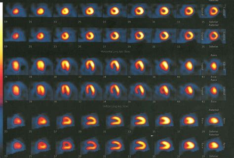 Myocardial Perfusion Imaging MPI Shows No Perfusion Defects Download Scientific Diagram