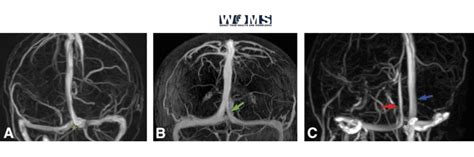 Normal As Well As Variant Anatomy Of The Dural Venous Sinuses Woms