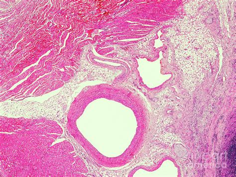 Fibrinous Pericarditis By Nigel Downer Science Photo Library