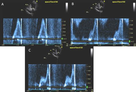 Increased Atrial Pacing Rate Requires Progressive Shortening Of Av