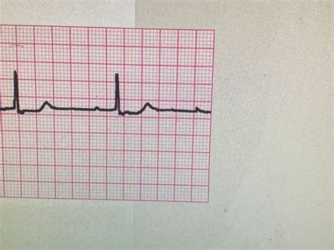 The Image Shows An Ecg Tracing The Studyx