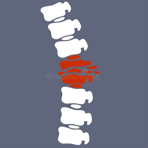 Problems With Spine Posture Issues Vertebral Column Stock Vector Illustration Of Design