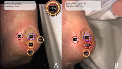 How Do You Know If Your Debridement Intervention Is Working Nirs