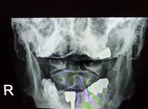 Hi Guys So I Wanted To Share This Odontoid View That I Got At Clinicals A Few Weeks Back Im A