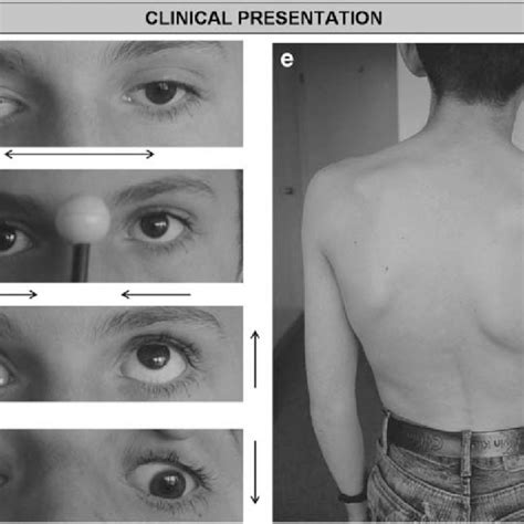 Clinical Presentation A Complete Absence Of Horizontal Gaze B Download Scientific Diagram