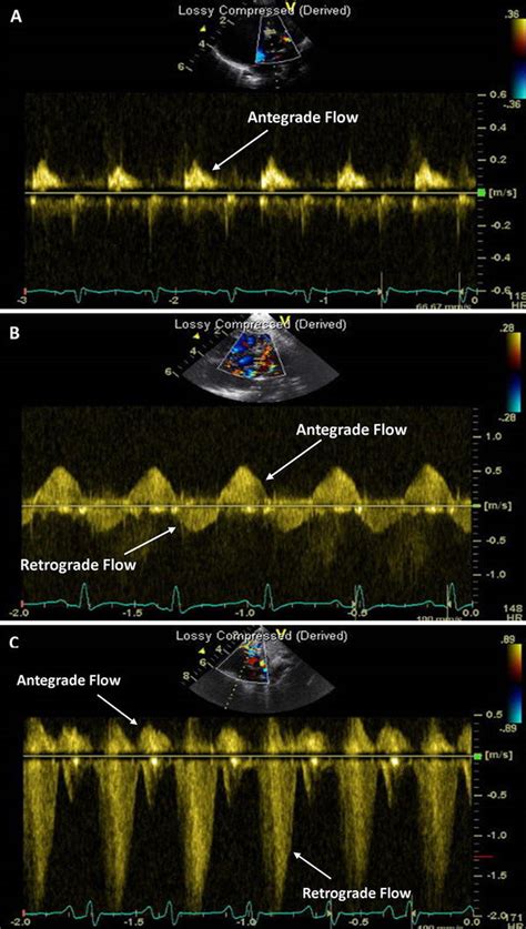 Coronary Flow Patterns By Spectral Doppler A Flow Pattern 1 With All Download Scientific