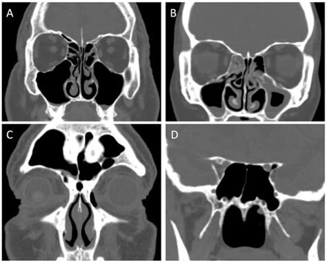 Sinusitis An Open Access Journal From MDPI