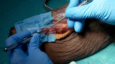 Video Author Spotlight Regenerative Peripheral Nerve Interface Rpni Surgery In