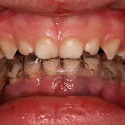 The Eva Copolymer Splint With The Flowable Resin Composite In The First