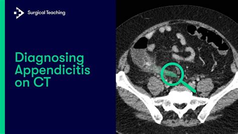 Diagnosing Appendicitis On Ct Youtube