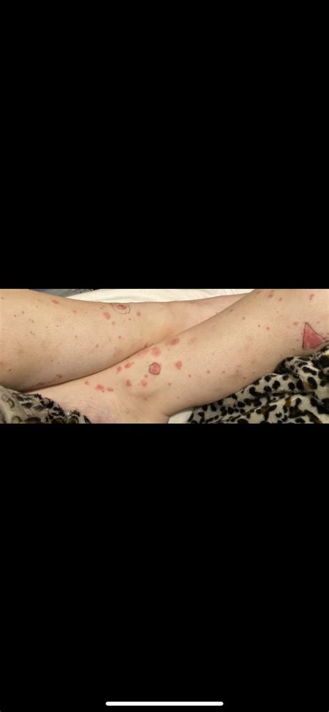 Non Blanching Rash Doctors Said It Didnt Look Like Meningitis And 2 Months Ago I Was Hiv Neg