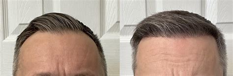 6 Months Post Ht 2600 Grafts R Hairtransplants