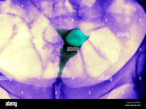 Fibrome utérin Banque de photographies et dimages à haute résolution Alamy