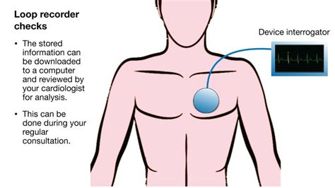 Loop Recorder Implantation Bayside Heart