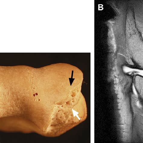 Pseudodefect Of The Capitellum Inferior View Of The Distal Humerus A Download Scientific