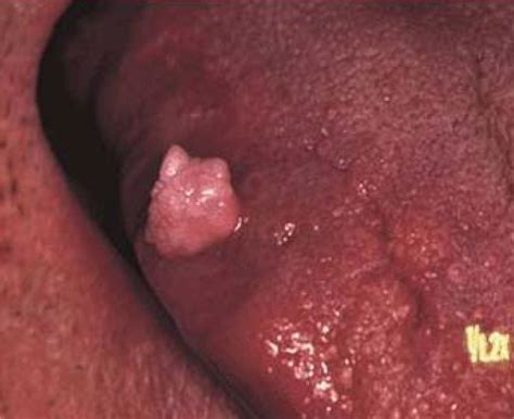 Hpv Infection And Related Oral Diseases European Association Of Oral Medicine