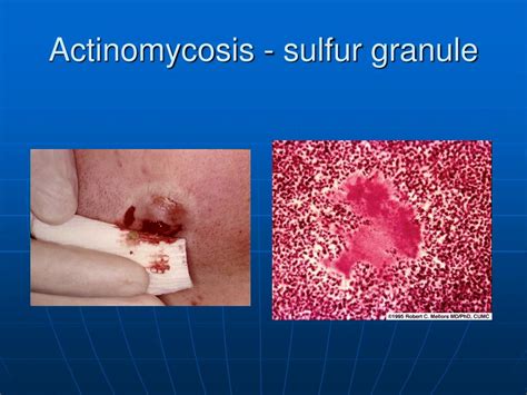 Actinomyces Sulfur Granules