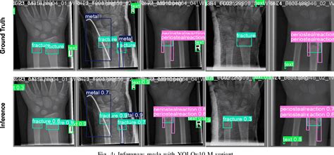 Figure 4 From Pediatric Wrist Fracture Detection In X Rays Via Yolov10