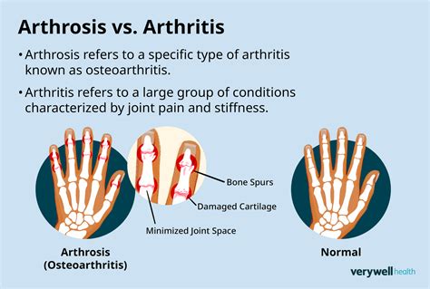 Arthrosis Vs Arthritis Different Causes And Symptoms
