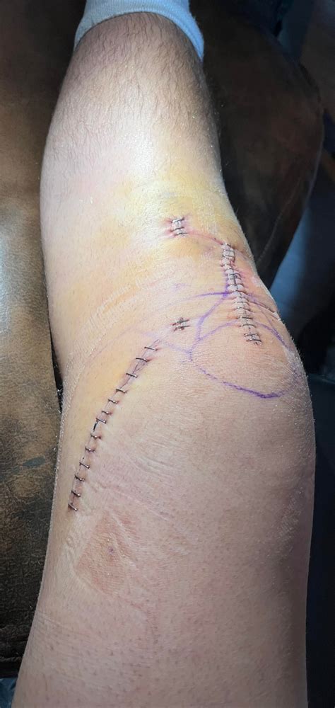 6 Days Post Acl Mcl Reconstruction Two Meniscus Repairs And Lemaire