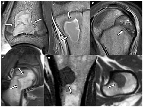 French Group Focuses Attention On Benign Bone Lesions Auntminnieeurope