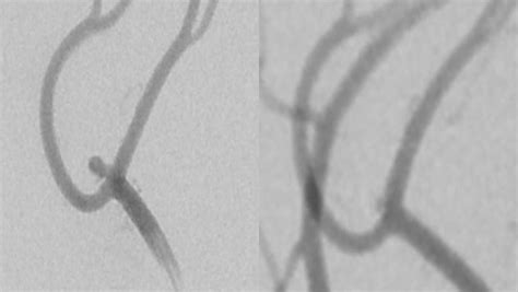 Treatment Of Recanalized Pericallosal Artery Aneurysm