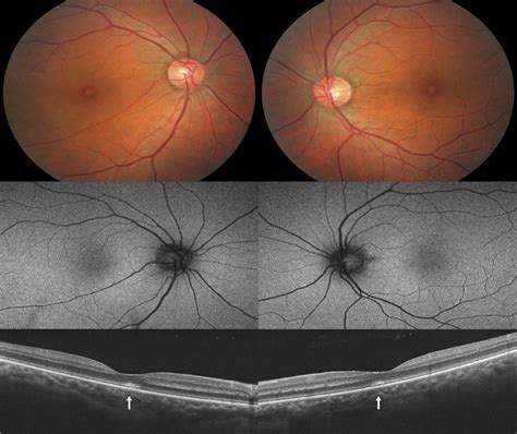 Reversible Bilateral Subfoveal Ellipsoid Zone Focal Thickeni