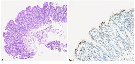 A Histology Image Showing The Duodenum Prior To Gluten Free Nutrition Download Scientific