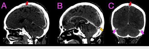 Computed Tomography Venogram Of The Brain Computerized Tomography