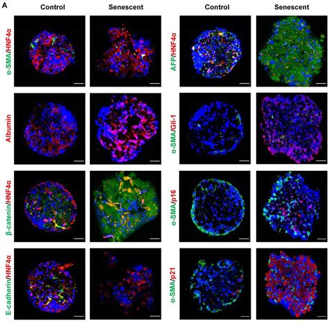 Secretome Of Senescent Hepatic Stellate Cells Favors Malignant Transformation From Nonalcoholic
